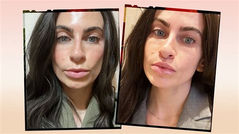 How I Really Feel About My Lip Lift Surgery — See My Before And After Photos Allure