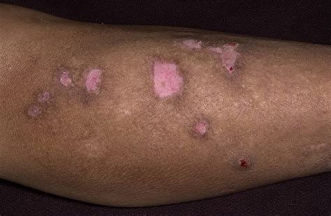 Senile Pruritus Pictures 48 Photos And Images