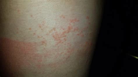 Hiv Rash Please Help R Std