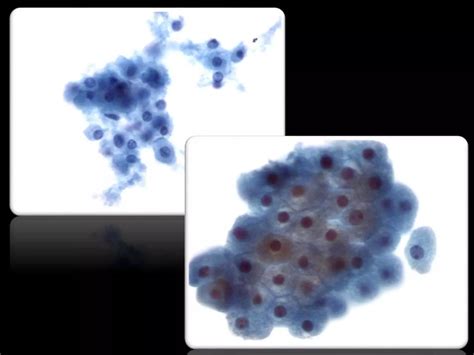 Role Of Cytology In Renal Lesions Pptx