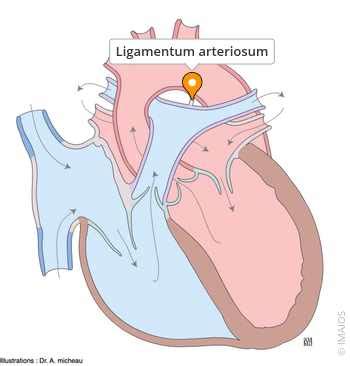 Ligamentum Arteriosum E Anatomy Imaios