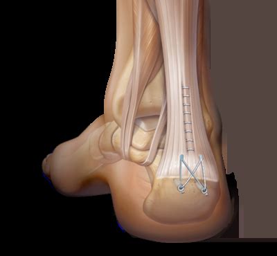 Achilles Tendon Reconstruction — Chicago Foot And Ankle Orthopaedic Surgeons