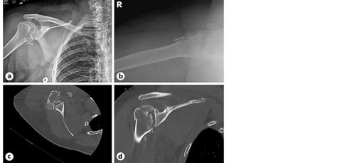 A Ap Radiograph Of Shoulder B Axillary Radiograph Of Shoulder