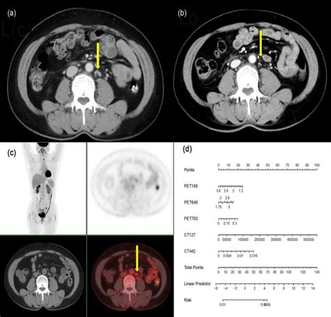 The Yellow Arrows Indicate The Para Aortic Lymph Node The Patient A Download Scientific