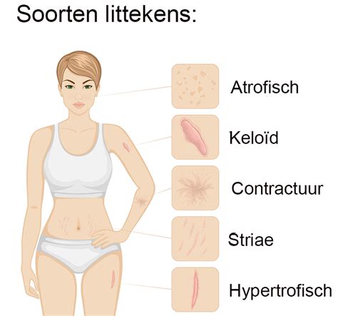 Striae And Littekens Pure Skin Balance Capelle Aan Den Ijssel