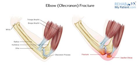 Elbow Olecranon Fracture Rehab My Patient Huesos Del Brazo