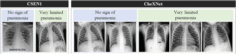 False Negatives Of The Csen1 And Chexnet Download Scientific Diagram