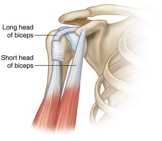 Biceps Tendinitis — Jonathan Koscso Md