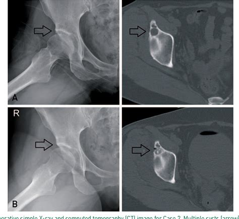 Subchondral Cyst