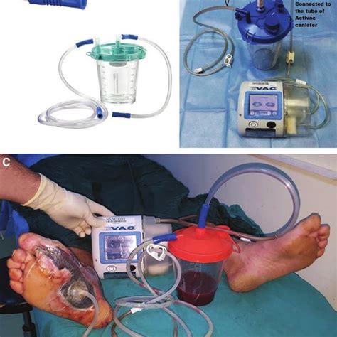 Vac Therapy System Modification Technique A The 1000 Ml Canister With