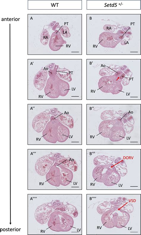 Setd5 Is Required In Cardiopharyngeal Mesoderm For Heart Development