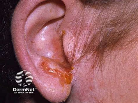 Otitis Externa Images — Dermnet