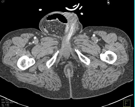 Small Bowel Hernia Into The Scrotum Small Bowel Radiology Case