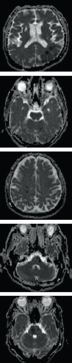 visualization examples of the mri slices and lesion segmentation download scientific diagram