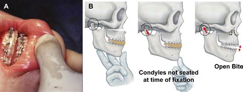 The Surgical Tools The Lefort I Bilateral Sagittal Split Osteotomy Of