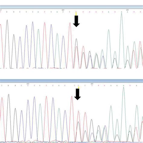 Chromatogram Showing The B Globin Gene With A 2 Bp Deletion At Codon