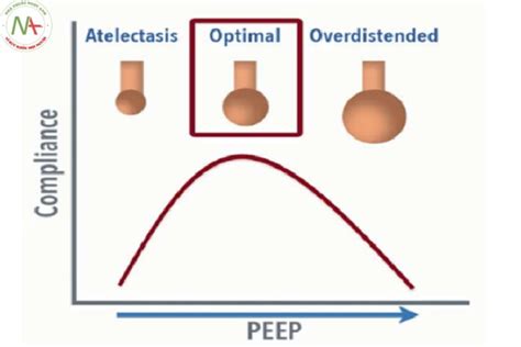Algorithm Cài đặt Máy Thở Ban đầu Cho Bệnh Nhân Ards