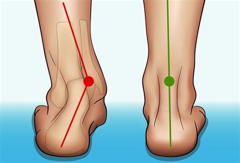 How Ankle Alignment Affects Your Posture