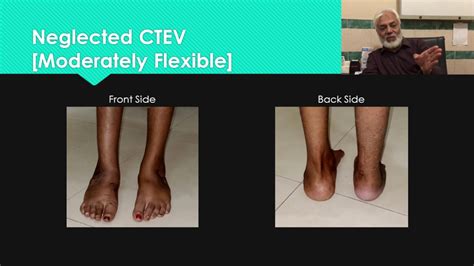 Management Of Neglected Ctev Clubfoot Lecture By Drafzal Hussain