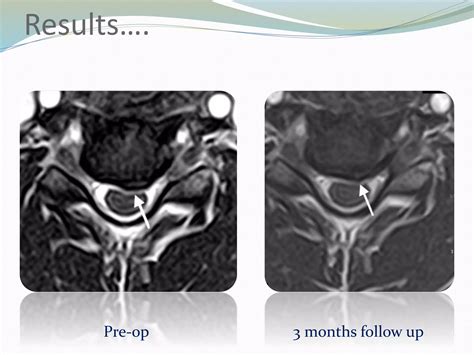 Cervical Nucleoplasty Pptx