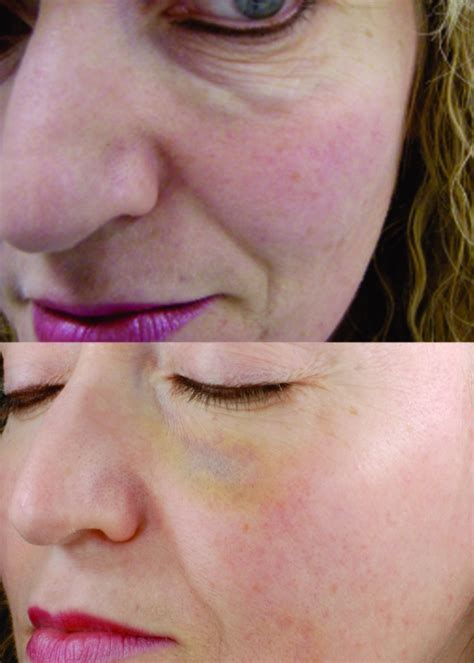 Avoiding Malar Edema During Midfacecheek Augmentation With Dermal