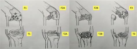 Hand Made Diagrammatic Representation Of The Aori Classification Of