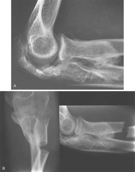 Ectopic Ossification About The Elbow Musculoskeletal Key