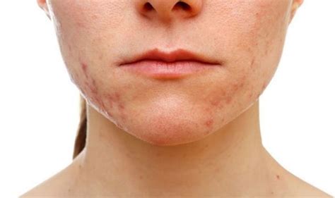 Hormonal Acne Jawline