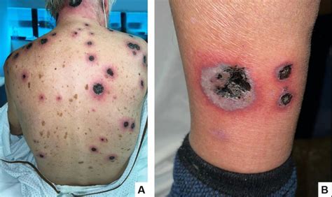 Ecthyma Gangrenosum Of Atypical Origin Internal And Emergency Medicine Springer Nature Link