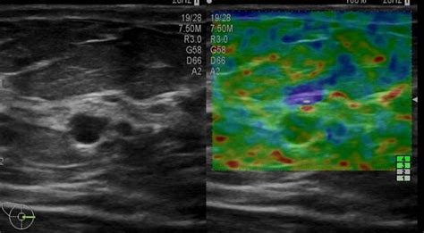 Breast And Axilla 54 Elastography Case 541 Elastography Benign
