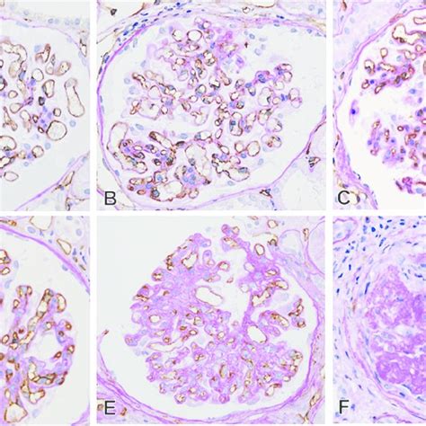 The Thickness Of Glomerular Capillary Walls μm In Mn Cases With And