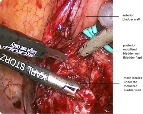 A Technique Of Laparoscopic Mesh Excision From The Bladder After Sacrocolpopexy Obgyn Key