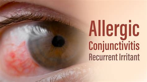 Allergic Conjunctivitis Youtube