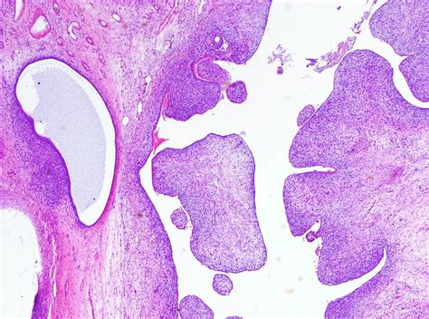 Pathology Outlines Adenosarcoma