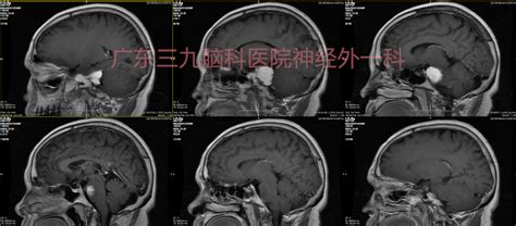 左侧跨中后颅窝岩斜区脑膜瘤切除术 脑医汇