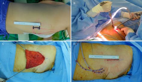 Endoscopy Assisted Muscle Sparing Latissimus Dorsi Muscle Flap