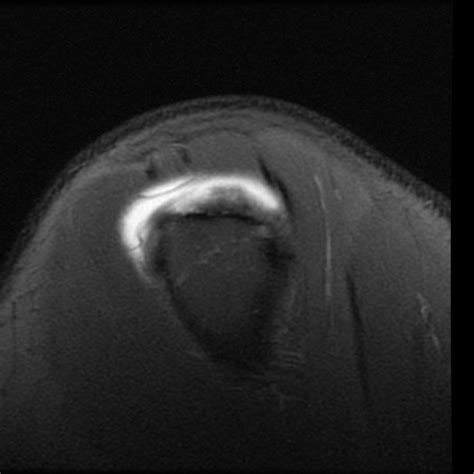 Filefull Thickness Supraspinatus Tear Hagl And Deficient Anteroinferior Labrum Mri Arthrogram Filefull Thickness Supraspinatus Tear Hagl And Deficient Anteroinferior Labrum Mri Arthrogram