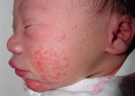 Neonatal Acne Acne Neonatal And Infantile Dermatology Advisor
