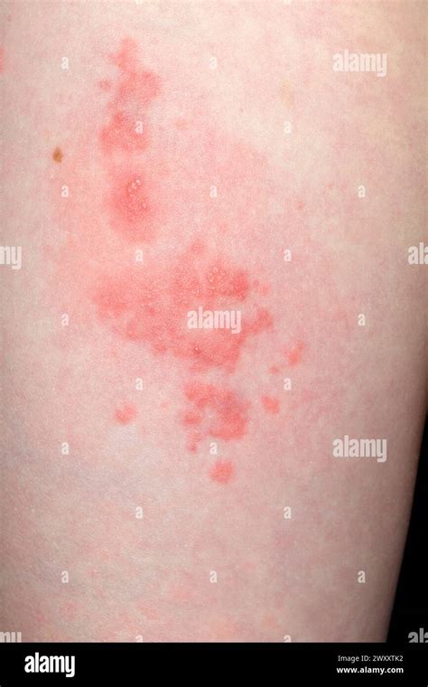 Rash On The Thigh Of A 7 Year Old Female Patient With Shingles Herpes