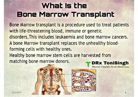 Bone Marrow Transplantation Drxtonisingh Pdf