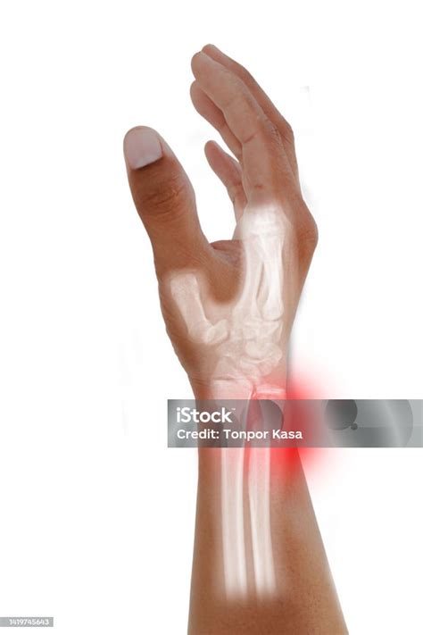 Photo Libre De Droit De Radiographie De La Main Et Du Poignet Vue