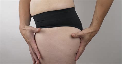 Cellulite On Female Thigh Obesity On The Legs On The Buttocks 11142094