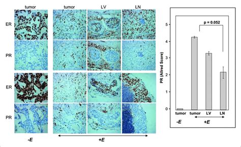 Er And Pr Expression In Triads Of Mcf 7 Tumors Lv Emboli And Ln