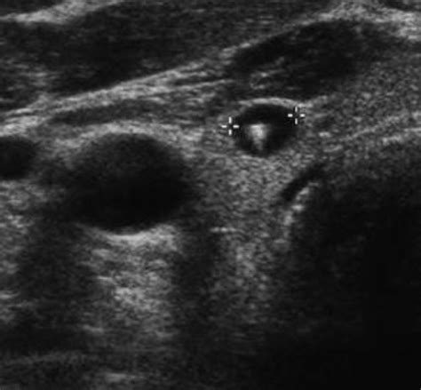 Thyroid Pathology Week 3 Flashcards Quizlet