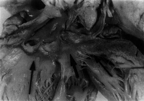 Left Ventricular Aortic Outflow Tract And Attachment Of The Anterior