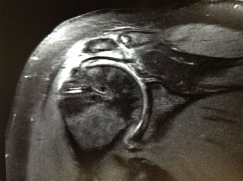 Postoperative Mri Arthrogram After A Rotator Cuff Bridging Procedure