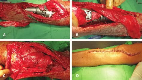 A An 18 Years Old Female With Osteosarcoma Of Proximal Tibia Download Scientific Diagram