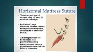 Suture Techniques Z Plasty Pptx