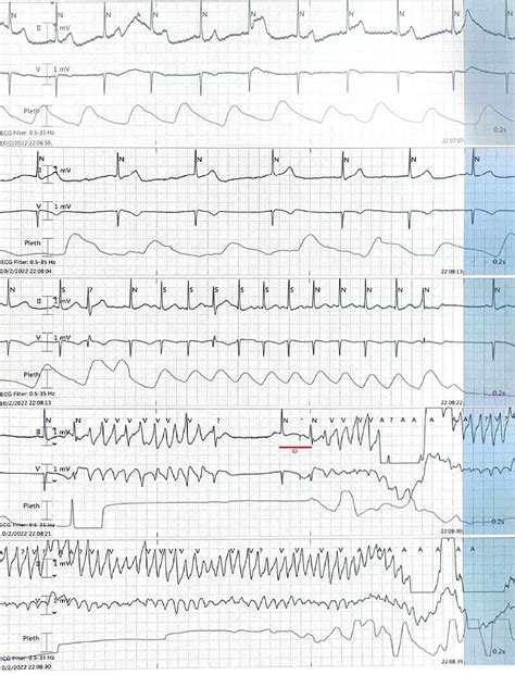 Micturition Syncopenot Always Benign Circulation