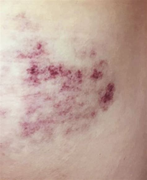 Compva Capillary Malformations